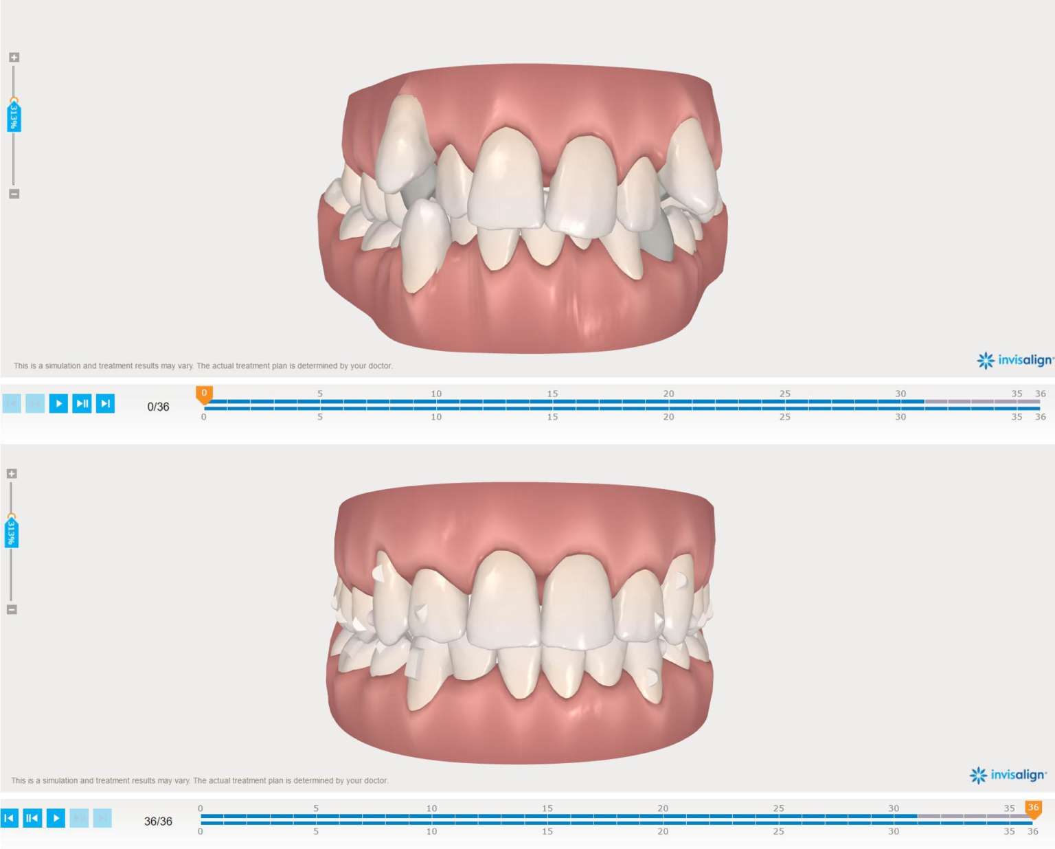 Tipos de tratamientos de Ortodoncia con Invisalign • Alba & Hernanz