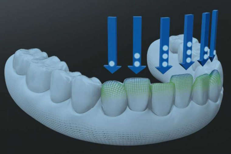 La novedad de Invisalign G8 • Alba & Hernanz