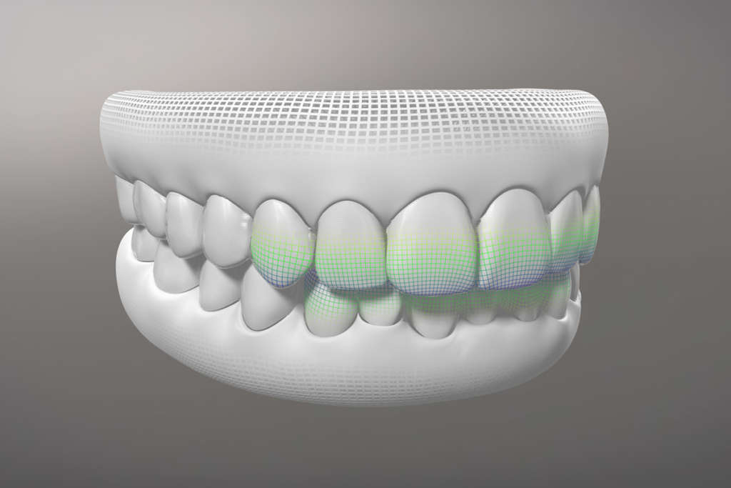 La novedad de Invisalign G8 • Alba & Hernanz